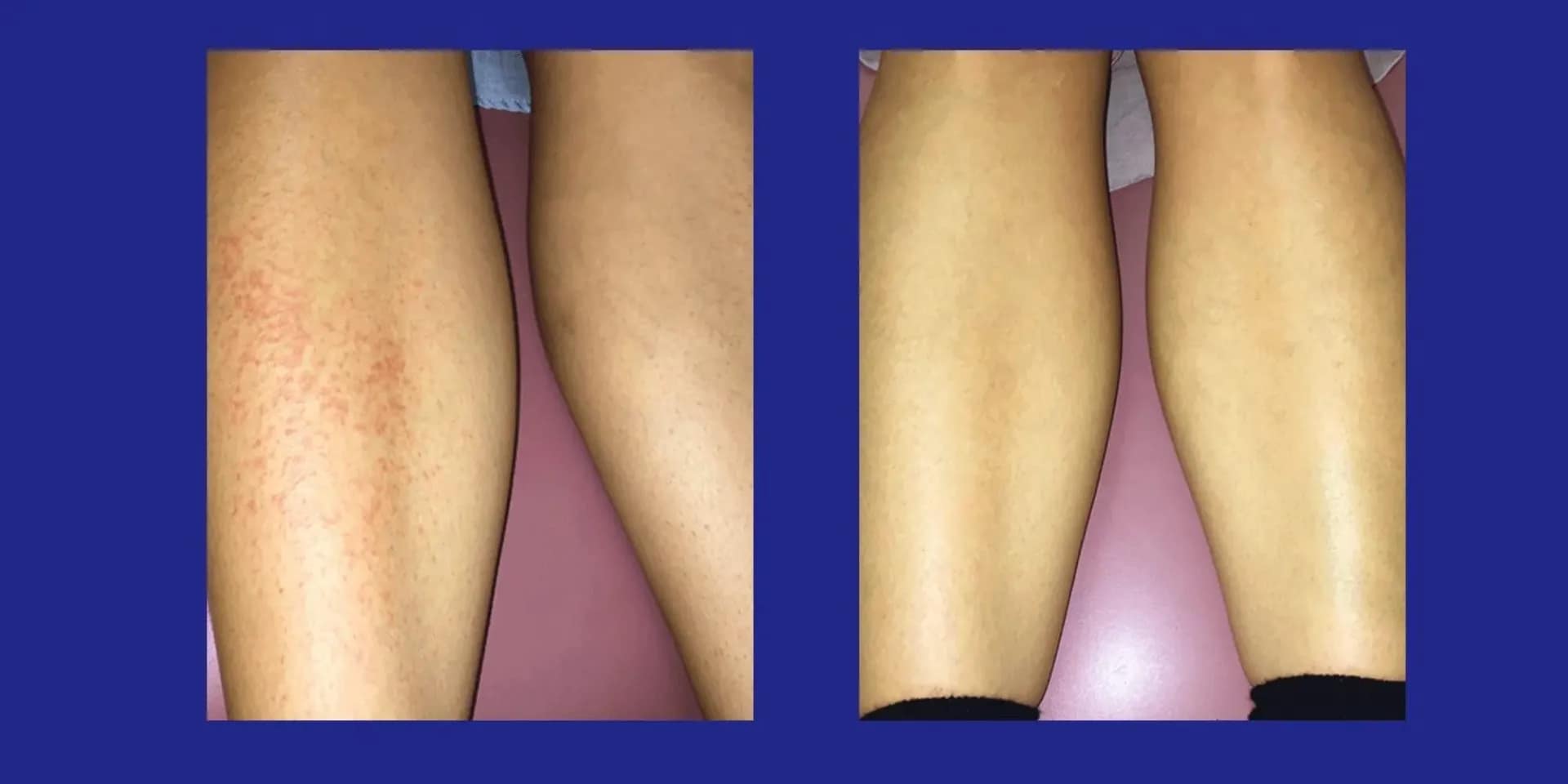 Measles on the Legs - Dr Garcia Biomagnetism