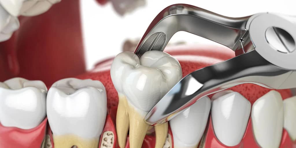 Wisdom Tooth Extraction NYC | Highline Dental Practice